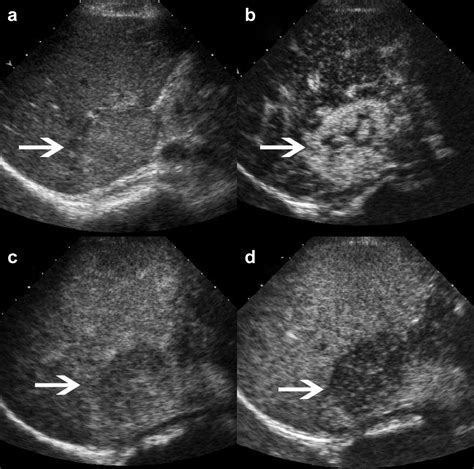 Role Of Portal Vein Tumor Thrombosis In Quantitative Perfusion Analysis