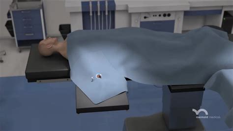 Mermaid Medical Group On Linkedin D Clot® Hd Thrombectomy System