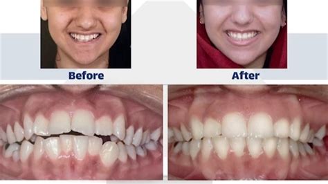 نمونه کار ارتودنسی دکتر نگار حدادی نماشا