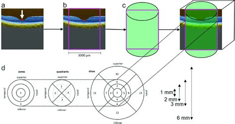 Choroidal Volume Measurements In A Right Eye A A Machine Learning Download Scientific Diagram