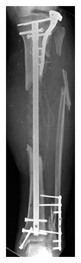 A Radiograph Of Open Tibial Fracture With Segmental Bone Loss As A Download Scientific