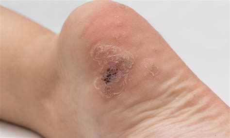 Plantar Warts