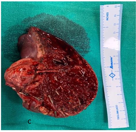 C Post Hepatectomy Specimen Download Scientific Diagram