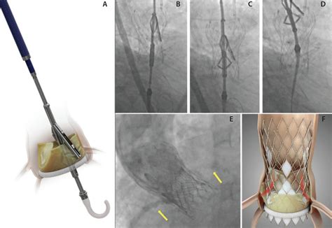 Shortcut™ Simplifying Complex Tavr With Leaflet Modification Cardiac Interventions Today