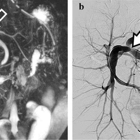 Ischemic Cholangiopathy In An 18 Month Old Girl Who Presented With