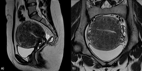 Аденомиоз и МРТ то что вы должны знать и о чем должны быть в курсе