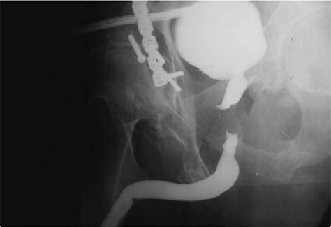Image Demonstrating The Length And Location Of A Pelvic Fracture