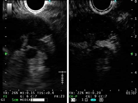 Contrast Enhanced Harmonic Endoscopic Ultrasound Appearance Of A