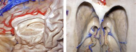 Anatomy Of The Ventricular System The Neurosurgical Atlas