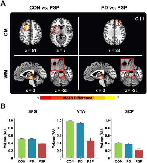 a vbm results showing between group differences in regional gm wm
