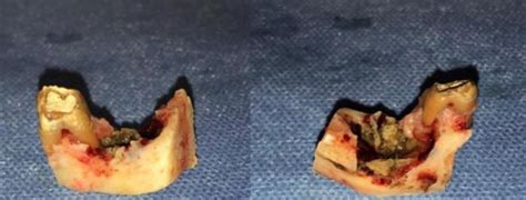 Necrotic Bone In The Alveolar Bone Region After Marginal Resection Of Download Scientific