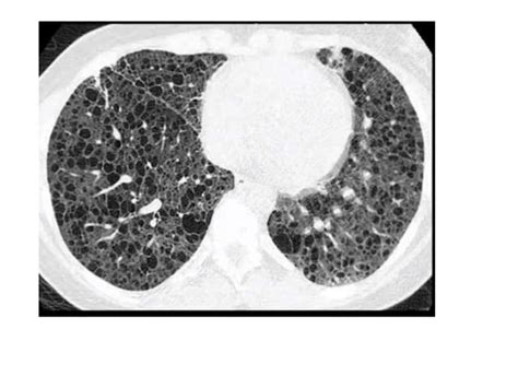 Interstitial Lung Disease Radiology Pptx