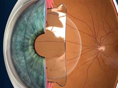 Aflibercept Eylea Anti Vegf Intravitreal Injection