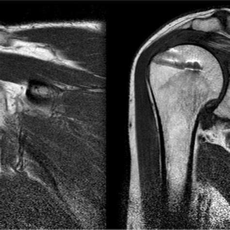 Bigliani S Classification Of Acromion Undersurface With Corresponding Download Scientific