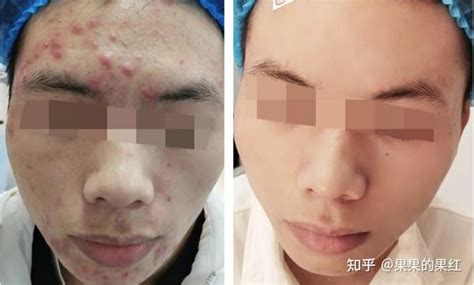 痘痘和粉刺是什么关系 它俩有什么区别 知乎