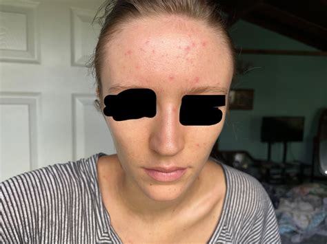 Forehead Texture And Redness Is A Persistent Problem R Skincare Addiction