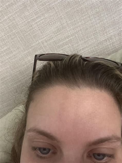 Possible To Have Morphea Or Ecds For Many Years Without Noticing Until Now R Scleroderma