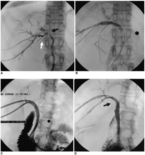 A 57 Year Old Male With Choledocho Choledochostomy After Living Donor Download Scientific