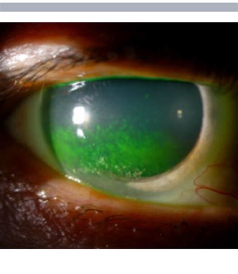 Opthalmology Flashcards Memorang