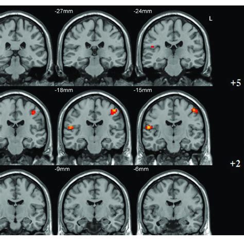 Statistical Maps Showing Nh Differences In The Right Rolandic Download Scientific Diagram