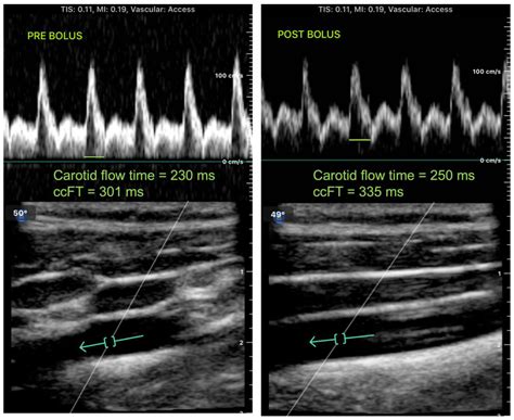 An Assessment Of Carotid Flow Time Using A Portable Handheld Ultrasound Device The Ideal Tool