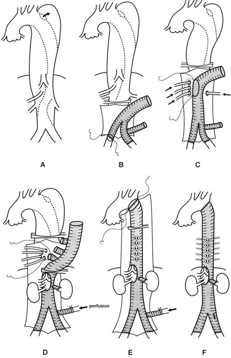 Figure 1 From Retrograde Segmental Aortic Repair For Type Ii