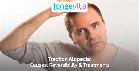 Traction Alopecia 101 What You Need To Know
