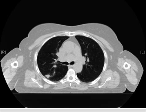 Ct Scan Of The Chest From 2004 Demonstrating Nodular Opacity In The
