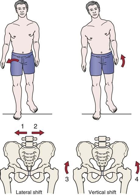 2 Pelvis Shift One Lateral Or Vertical Shift Occurs And Then The