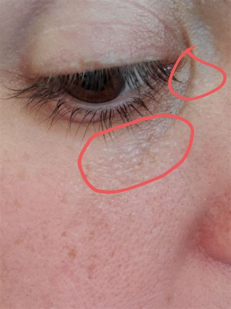 Under Eye Bumps Not Milia Beauty Insider Community