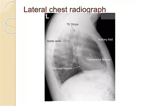 Tracheobronchial Tree 1 Pptx