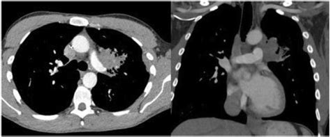 Transformed Testicular Teratoma To Embryonic Type Neuroectodermal Tumor With Metastasis To