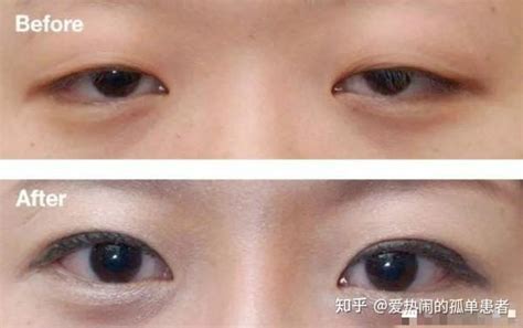 杭州双眼皮攻略测评 知乎
