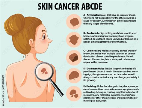 Skin Cancer Abnormal Growth Of Skin Cells Infographic Stock Vector