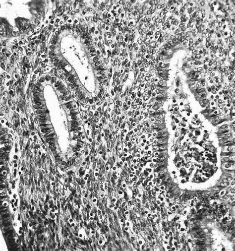 Pathology Outlines Endometriosis