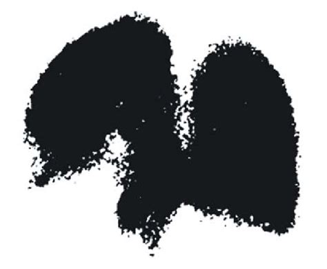 Lung Perfusion Scan Indicating Perfusion Defects In The Left Lower Lobe Download Scientific