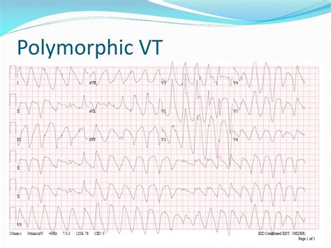 Ppt What To Do If Called For An Arrhythmia Powerpoint Presentation Free Download Id 5450309