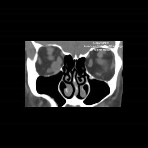 PHILIPS每日一例经典眼眶内静脉曲张一例 MedSci cn