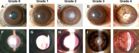 Appearance Of Anterior Segment And Iris Transilluminati Open I