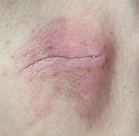 The Patients Pacemaker Pouch Download Scientific Diagram