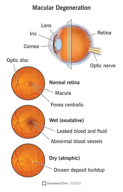 Macular Types Causes Symptoms And Treatment