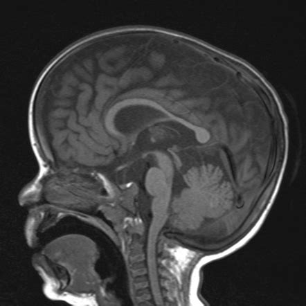 Achondroplasia Radiology Reference Article