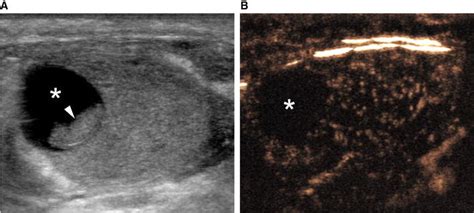 Incidentally Detected Complex Testicular Cyst A Gray Scale Download Scientific Diagram