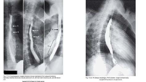 Radiographic Positioning Of The Esophagus Youtube