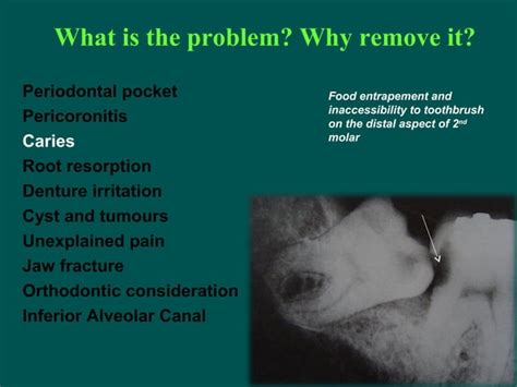 Lower 3rd Molar Impaction Its Assessment And The Buccal Approach Vz The Lingual Split Technique