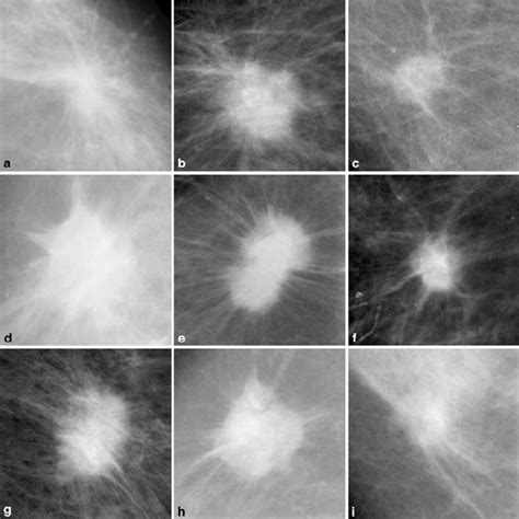 Examples Of Spiculated Masses We Can See That There Is A Great Download Scientific Diagram