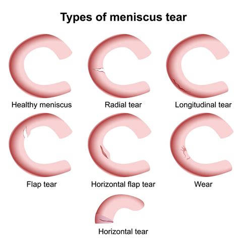 Is An Acl Tear Worse Than A Meniscal Tear Jacksonville Orthopaedic