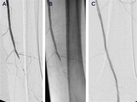 Directional Atherectomy And Drug Coated Balloon Therapy For Leaving Nothing Behind