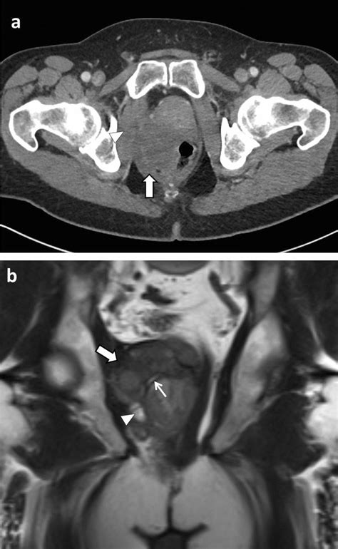 44 Year Old Man With Prostatic Synovial Sarcoma Presented With Perineal