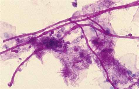 Candidiasis Histopathology Medizzy